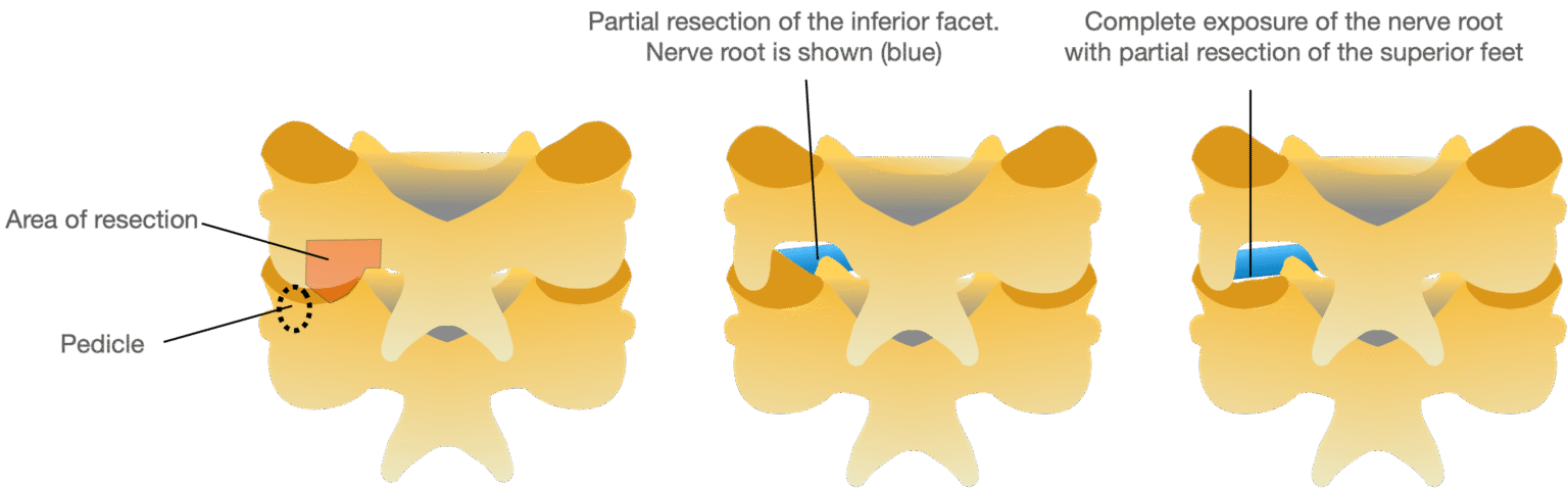Posterior cervical foraminotomy - Spine and Nerves